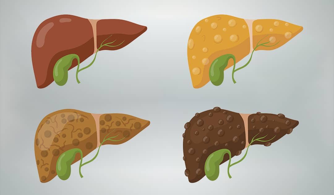 Chronic liver cirrhosis disease treatment: A Holistic Approach liver ...